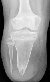 Amputations - Trauma - Orthobullets